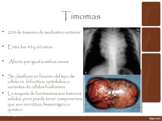 Tumores de mediastino
