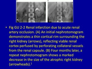 2 unilateral small, smooth kidney | PPT