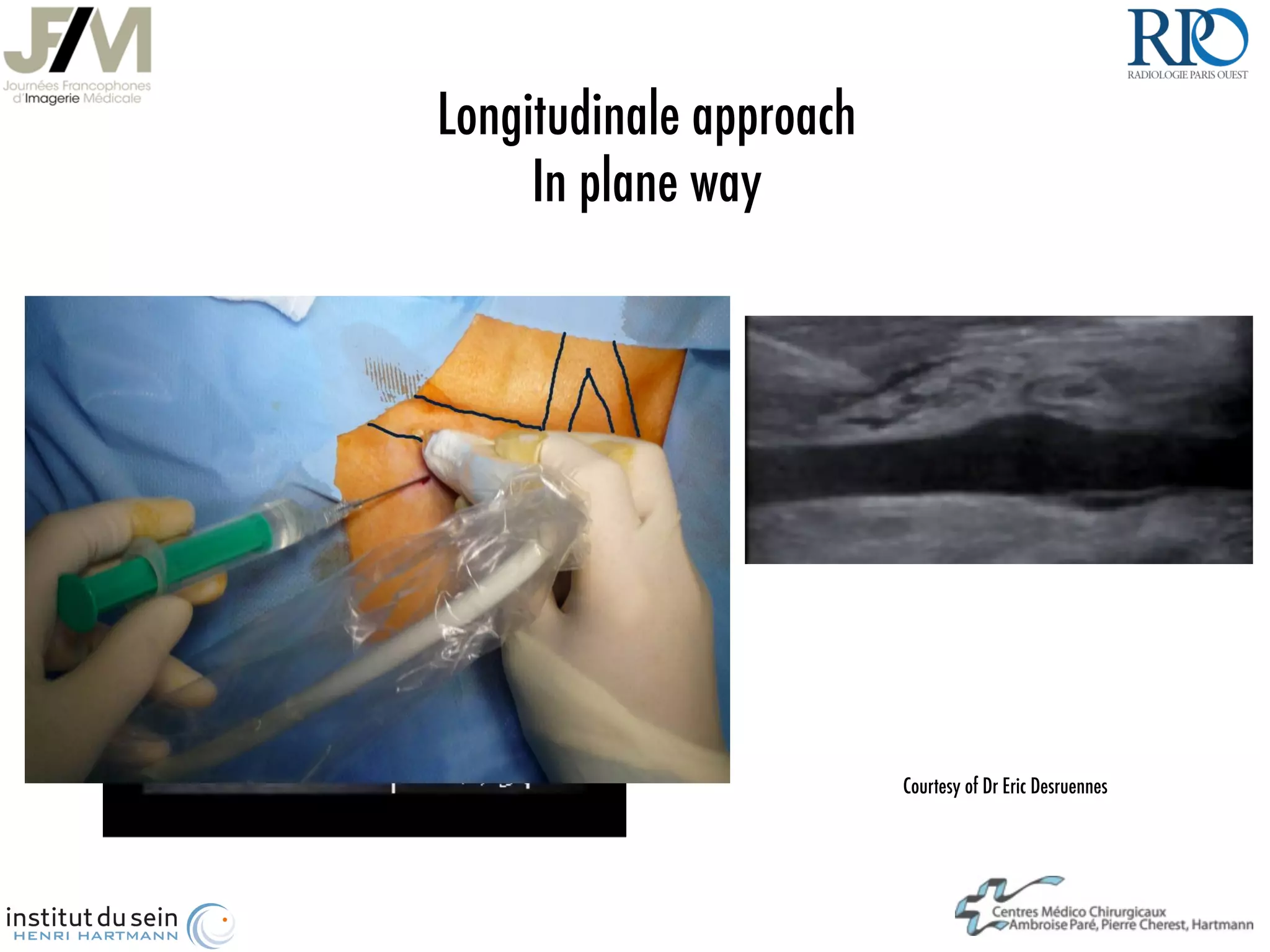 US Guidance venous access puncture in chest port imlantation . Luc ...
