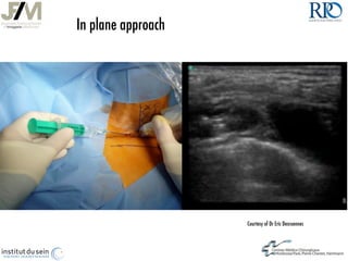 US Guidance venous access puncture in chest port imlantation . Luc ...