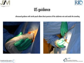 US Guidance venous access puncture in chest port imlantation . Luc ...
