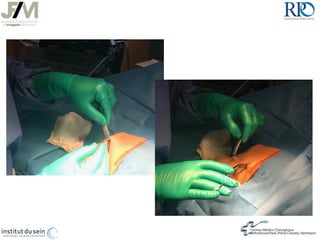 US Guidance venous access puncture in chest port imlantation . Luc ...