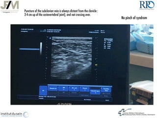 US Guidance venous access puncture in chest port imlantation . Luc ...