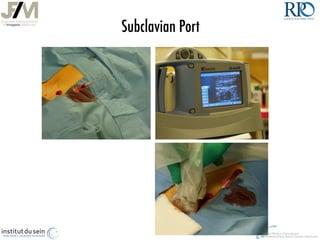 US Guidance venous access puncture in chest port imlantation . Luc ...