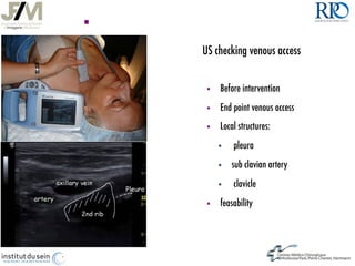 US Guidance venous access puncture in chest port imlantation . Luc ...
