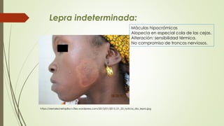 Características clínicas lepra jun 015 sss | PPTX