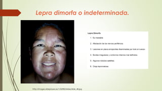 Características clínicas lepra jun 015 sss | PPTX