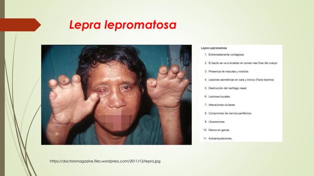 Características clínicas lepra jun 015 sss | PPTX
