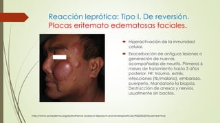Características clínicas lepra jun 015 sss | PPTX