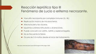 Características clínicas lepra jun 015 sss | PPTX