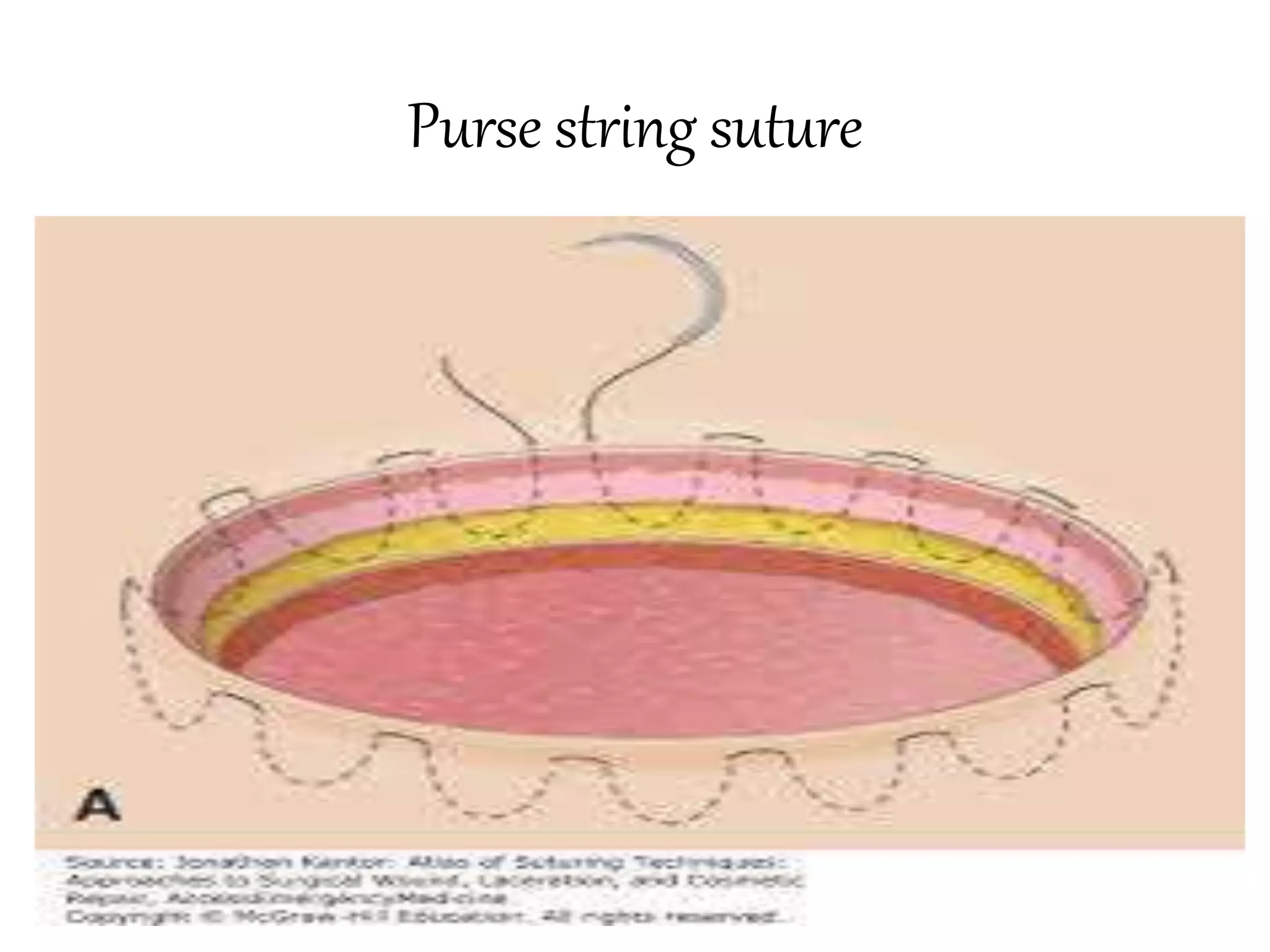 ventricular septal defect | PPTX