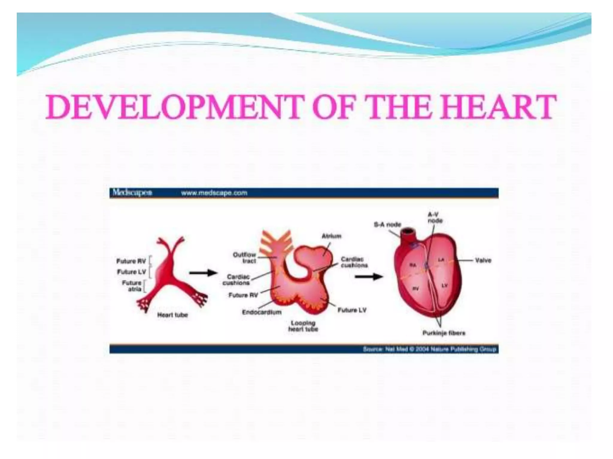 Ventricular Septal Defect Ppt
