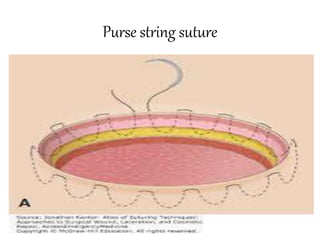 ventricular septal defect | PPT