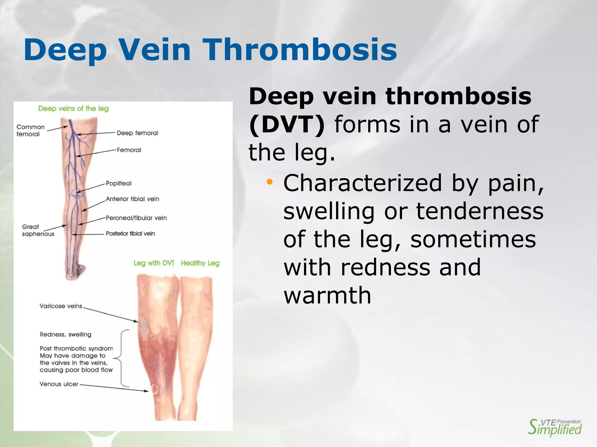 VTE Prophylaxis Focus on Prevention | PPT