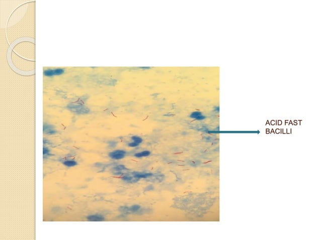 Ziehl-Neelsen n stain / Acid fast stain | PPTX | Alcoholic Beverages ...