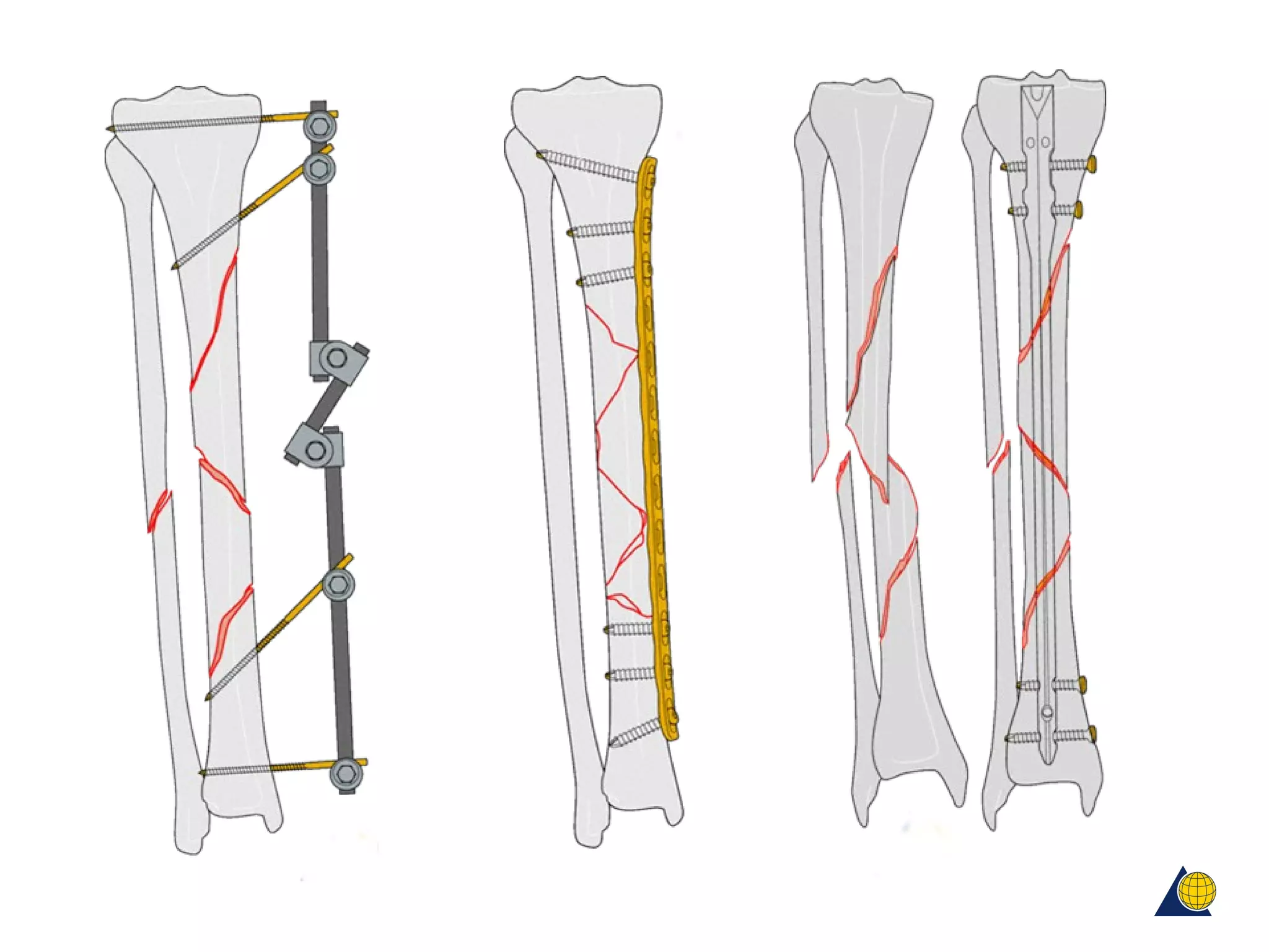 Biomechanics and biology of relative stability | PPT