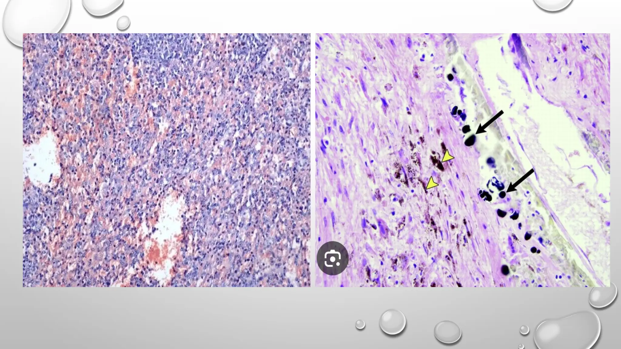 Splenomegaly , Hypersplenism etiology , pathology | PPTX