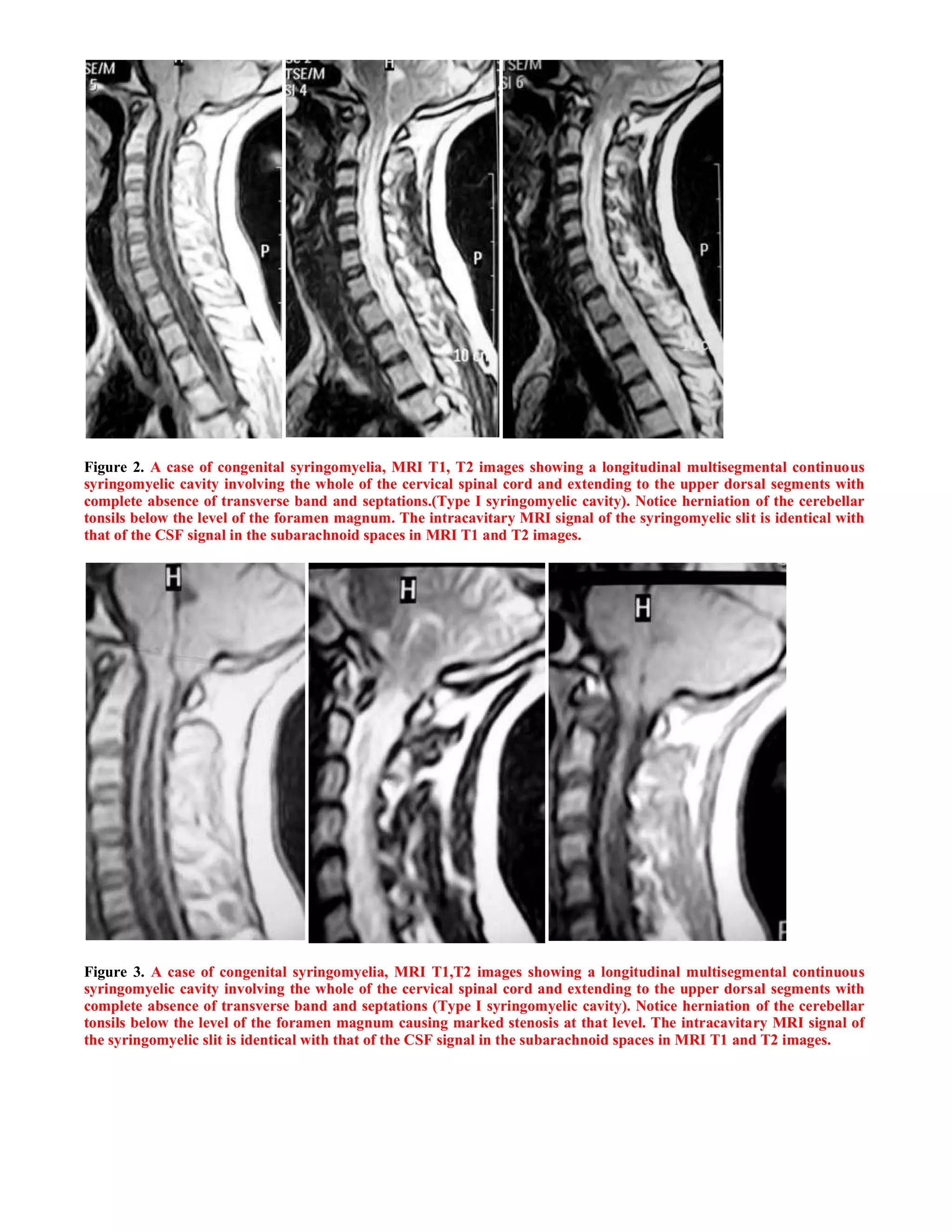 Case record...Congenital syringomyelia | PDF