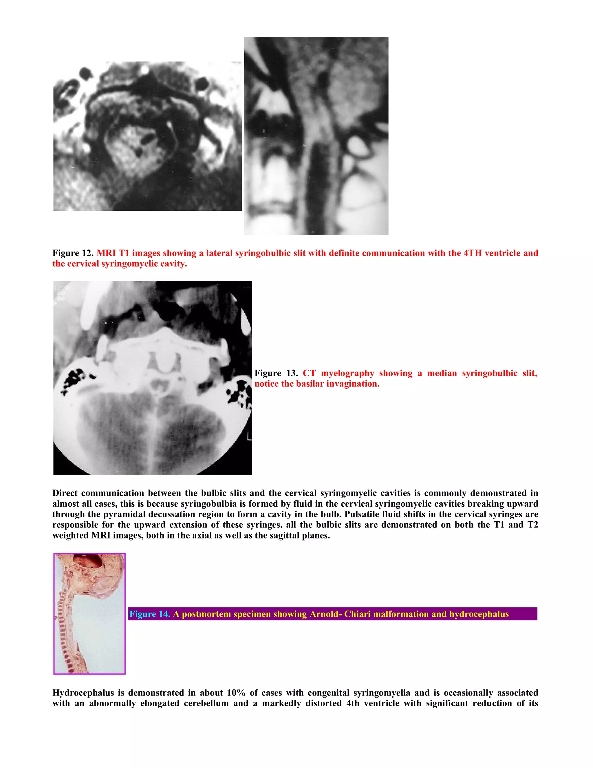 Case record...Congenital syringomyelia | PDF