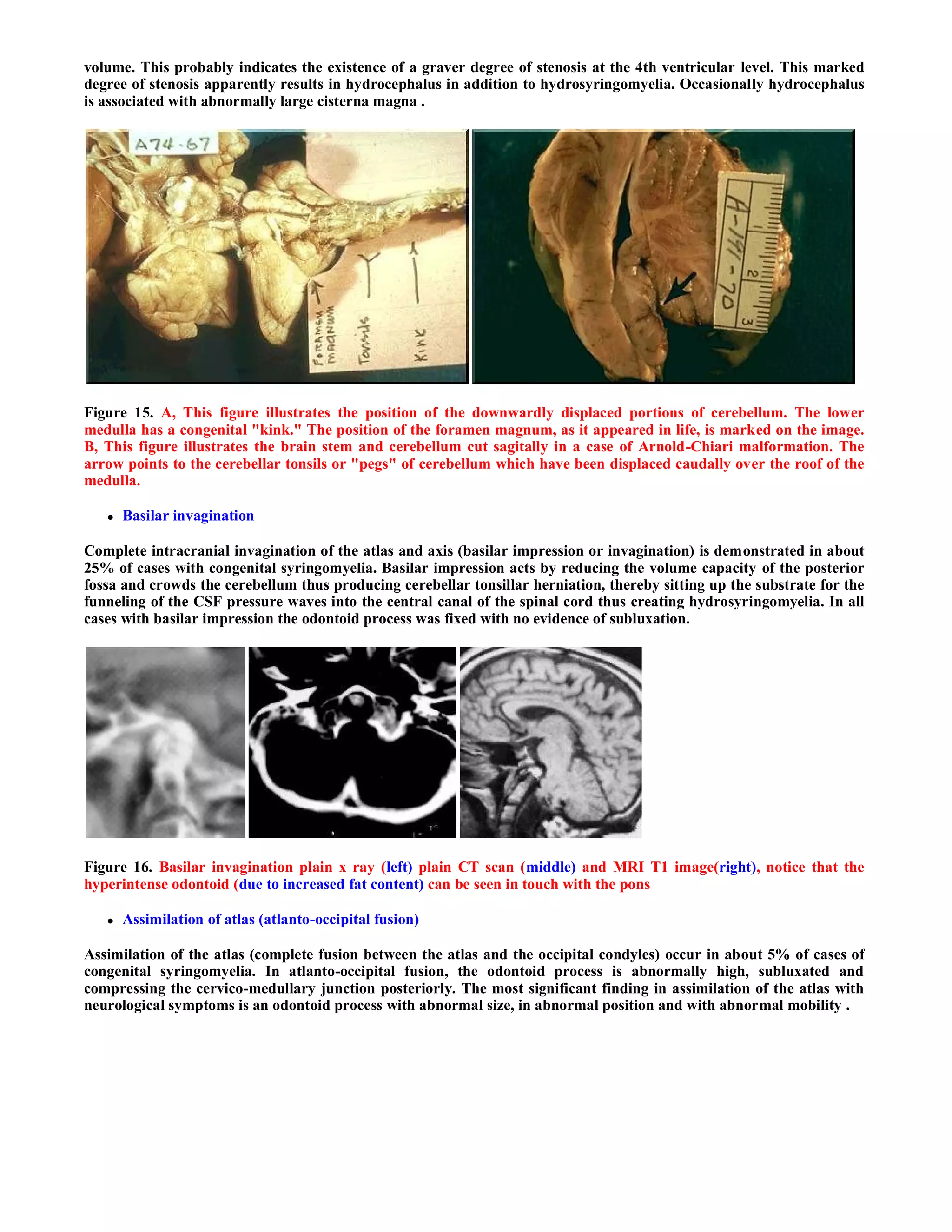 Case record...Congenital syringomyelia | PDF
