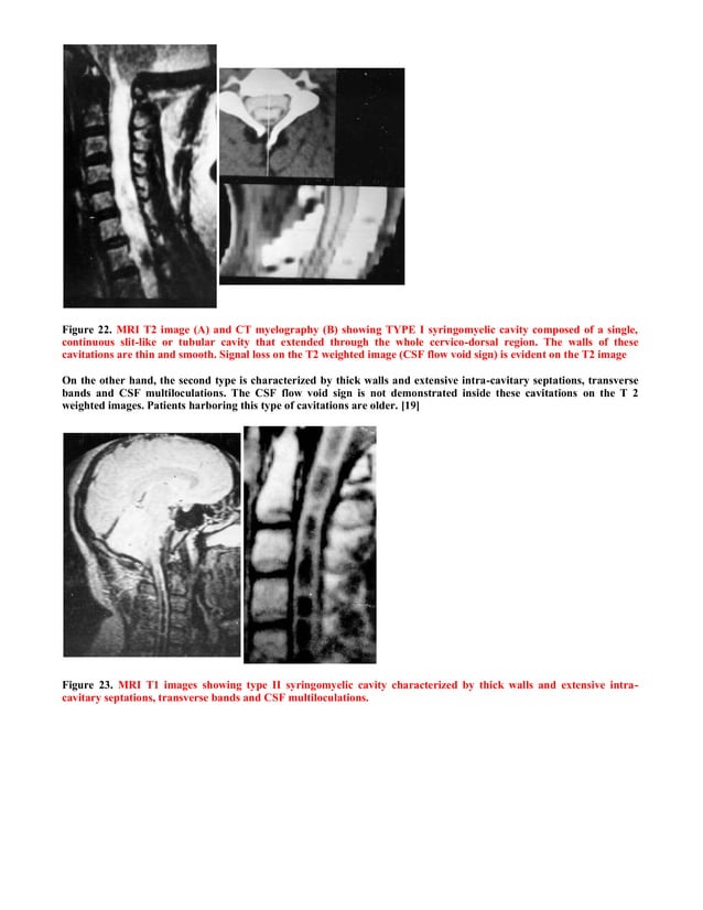 Case record...Congenital syringomyelia | PDF