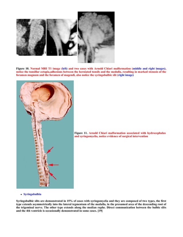Case record...Congenital syringomyelia | PDF