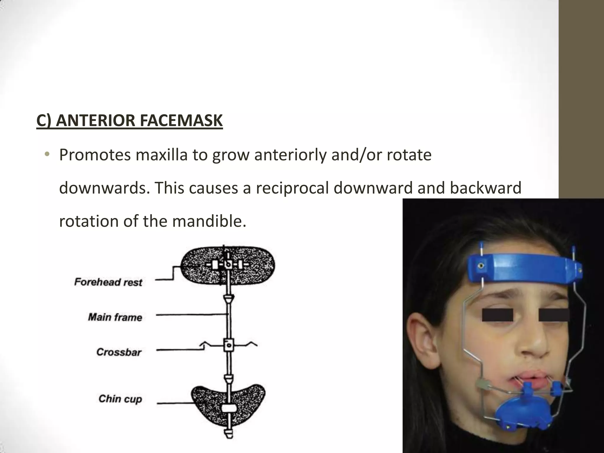 3.management of angles class iii malocclusion | PPTX