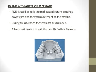 3.management of angles class iii malocclusion | PPTX