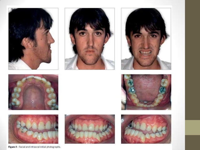 3.management of angles class iii malocclusion | PPTX | Dental Health ...