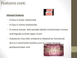 3.management of angles class iii malocclusion | PPTX