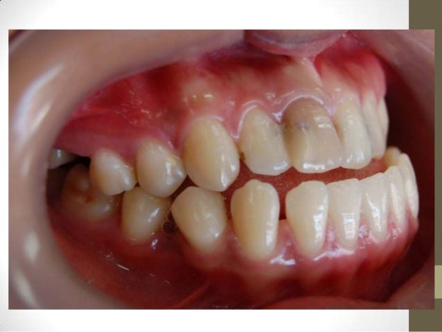 3.management of angles class iii malocclusion