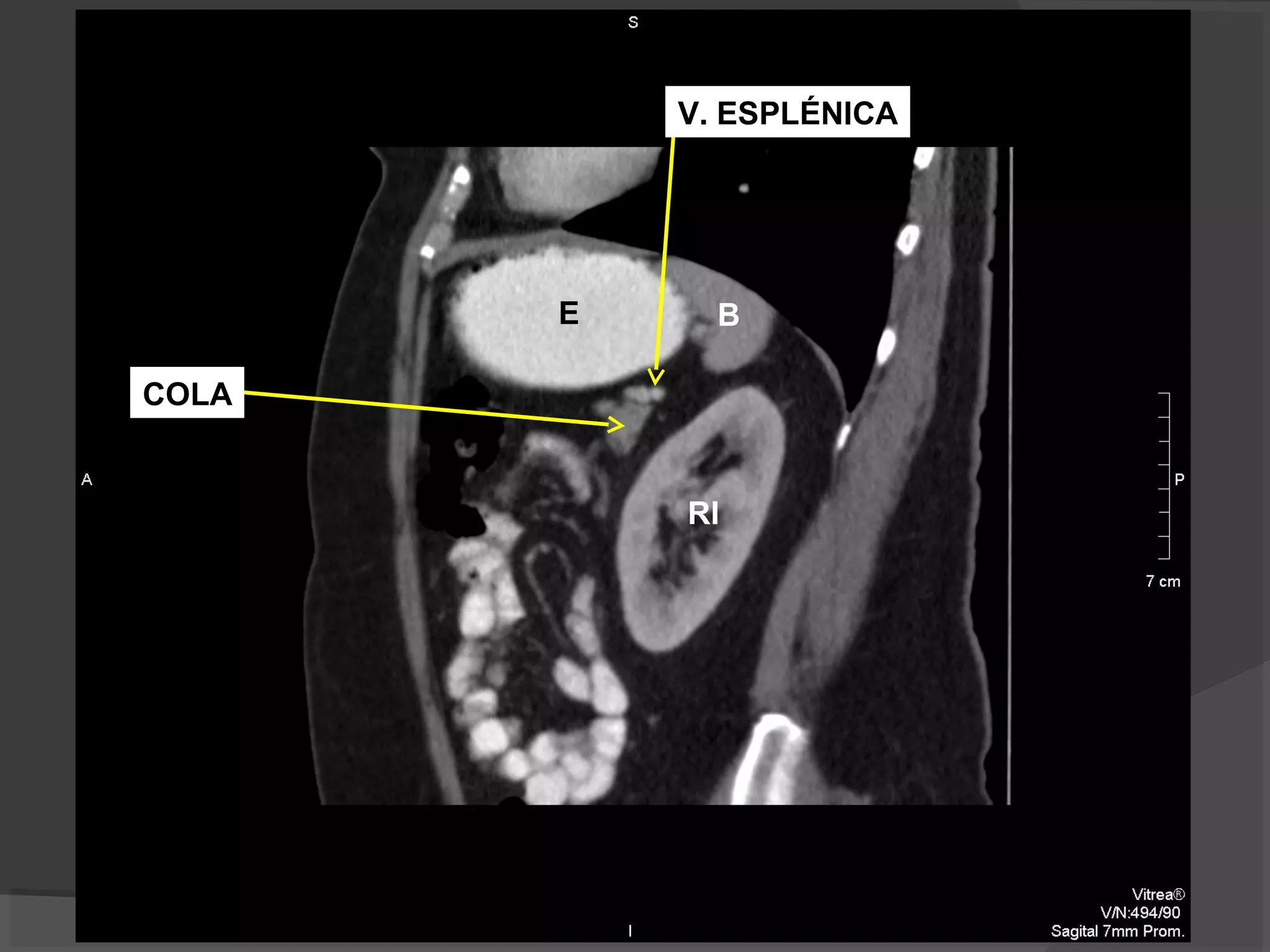 Clase de pancreas - TC | PPT