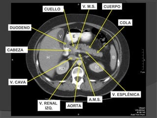 Clase de pancreas - TC | PPT