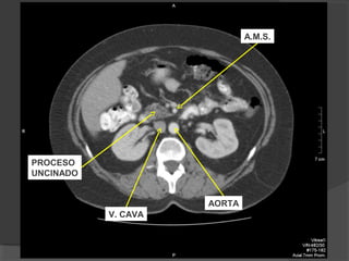Clase de pancreas - TC | PPT