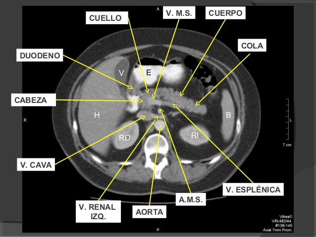 Clase de pancreas - TC