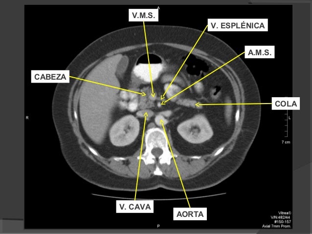 Clase de pancreas - TC