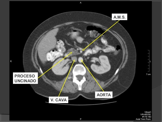 Clase de pancreas - TC