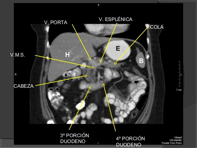 Clase de pancreas - TC