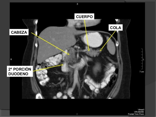 Clase de pancreas - TC