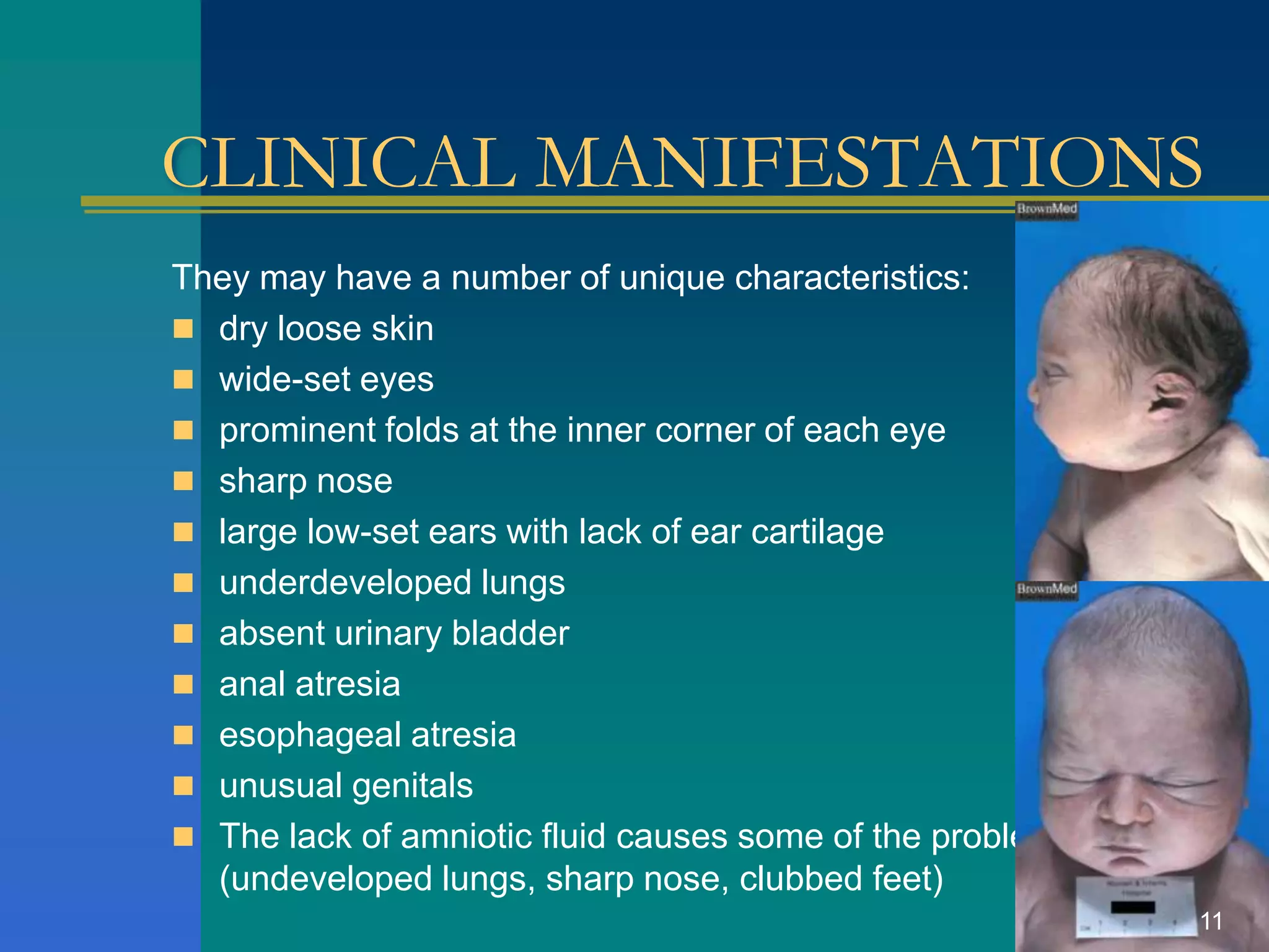 congenital anomalies of renal system | PPSX