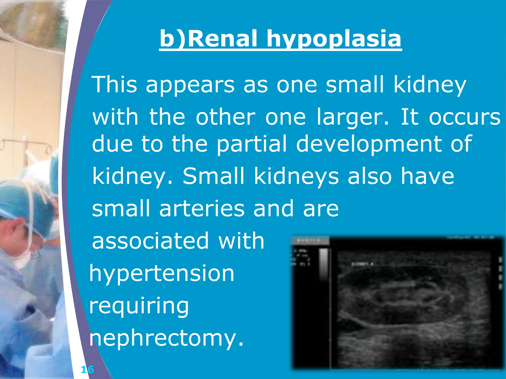 congenital anomalies of renal system | PPSX