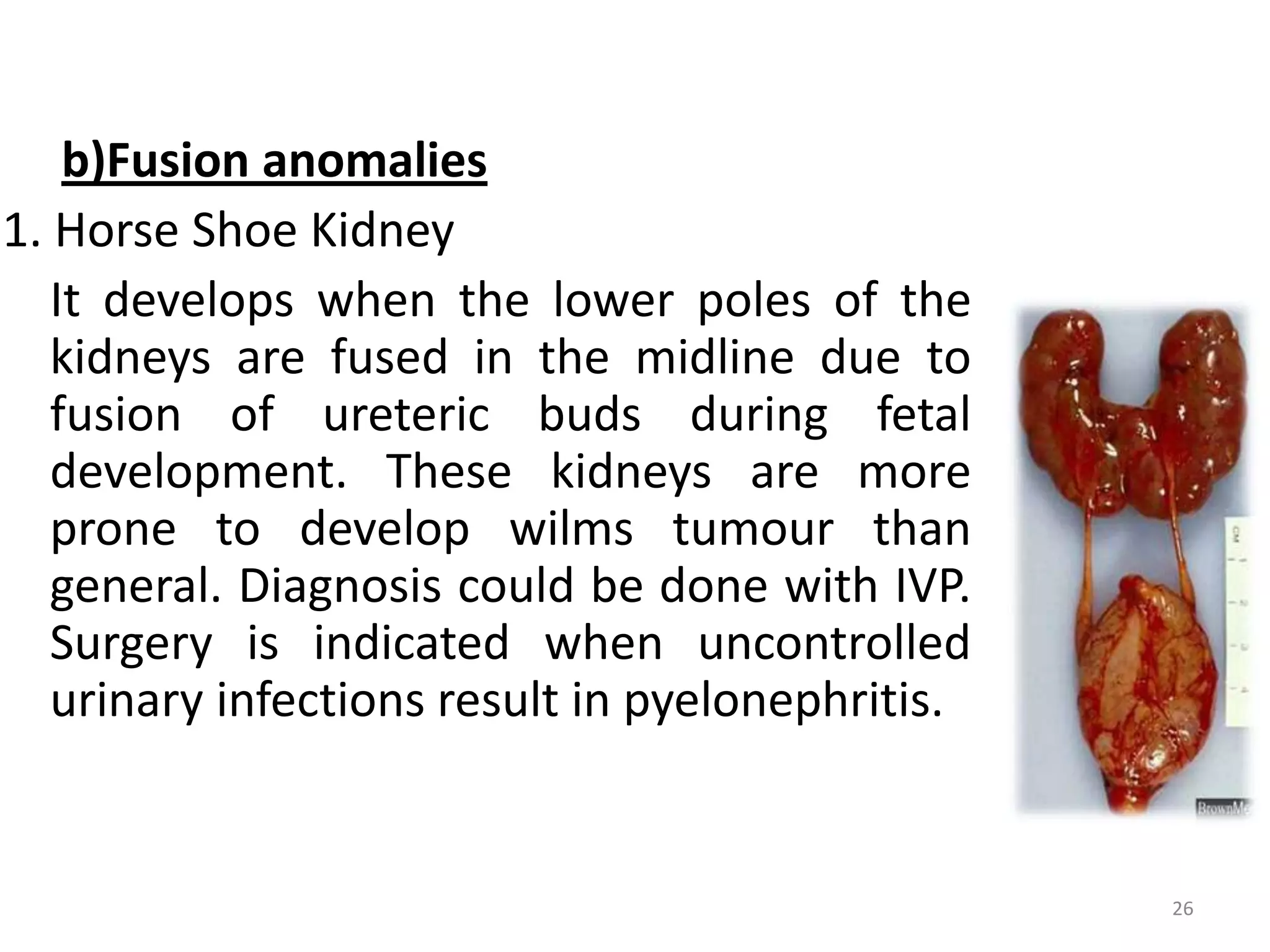 congenital anomalies of renal system | PPSX