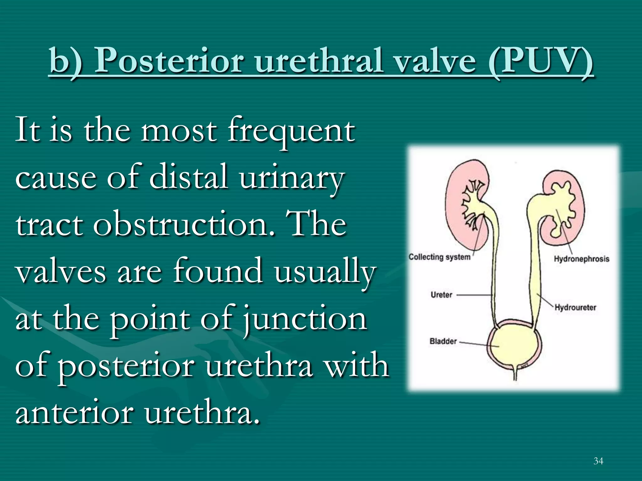 congenital anomalies of renal system | PPSX