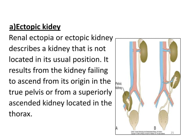 congenital anomalies of renal system | PPSX | Pregnancy | Reproductive ...