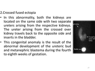 congenital anomalies of renal system | PPSX