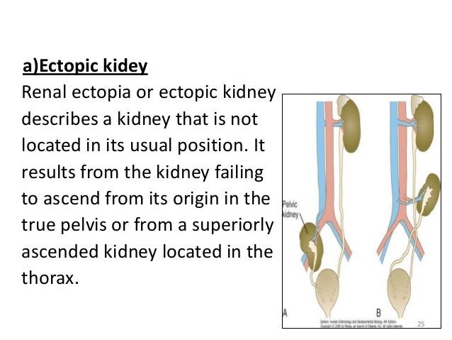 congenital anomalies of renal system