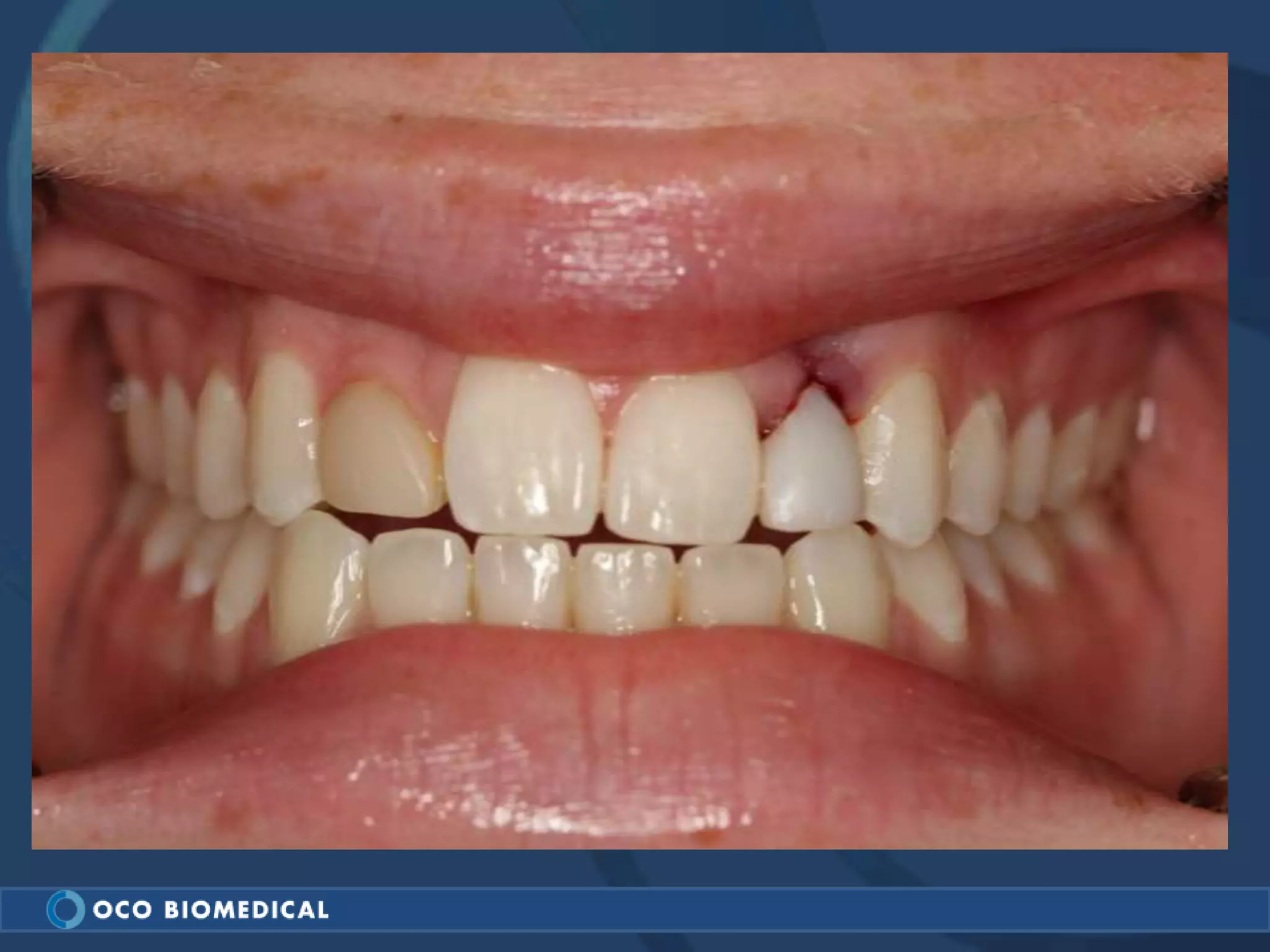 OCO Biomedical 3.0 Maxillary Laterals | PPTX