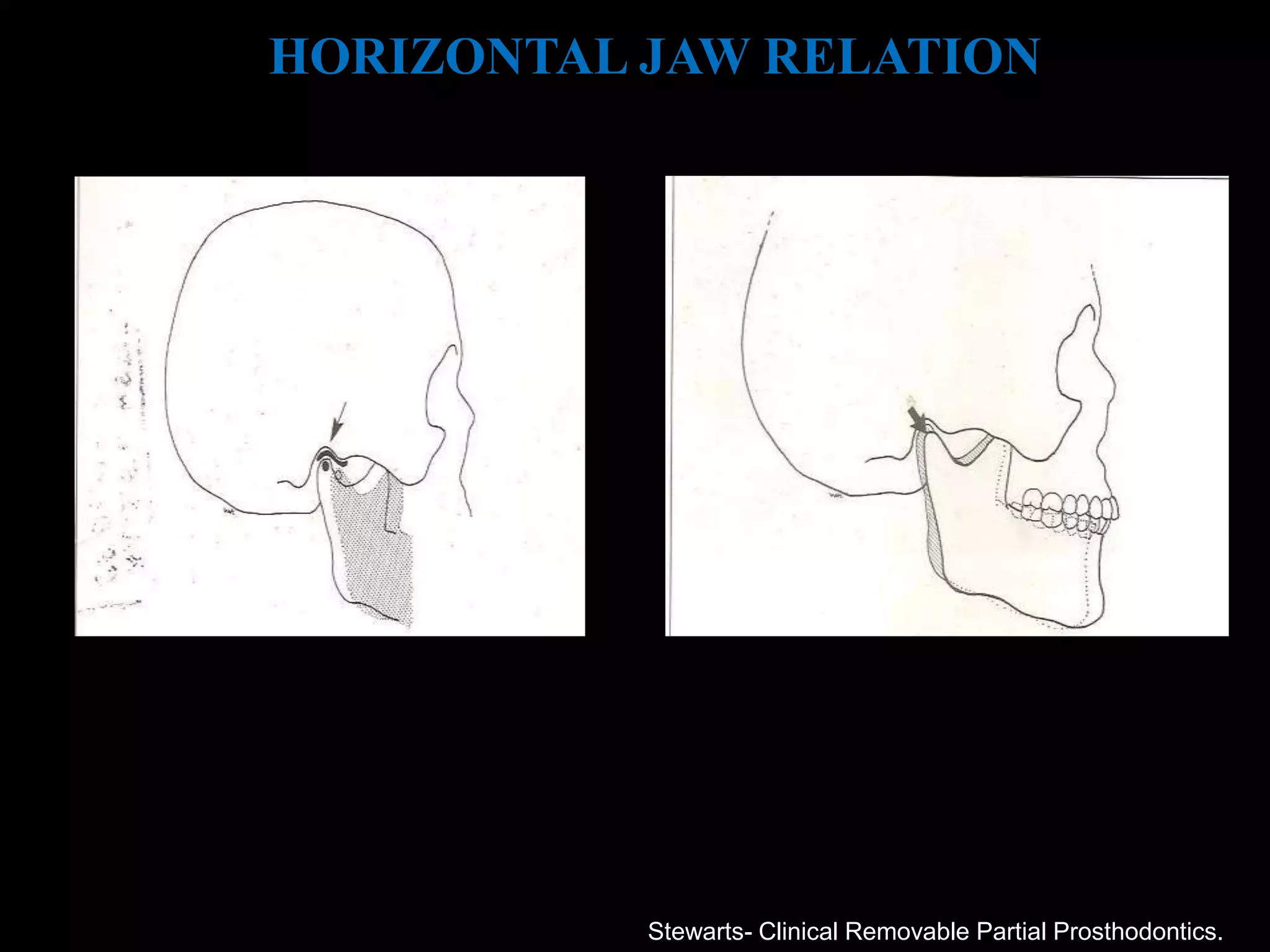 3.jaw relation and occ in rpd | PPTX