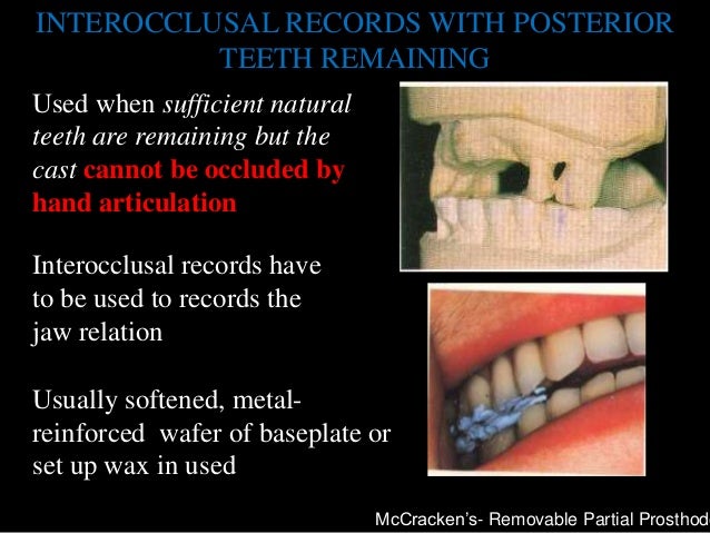 3.jaw relation and occ in rpd