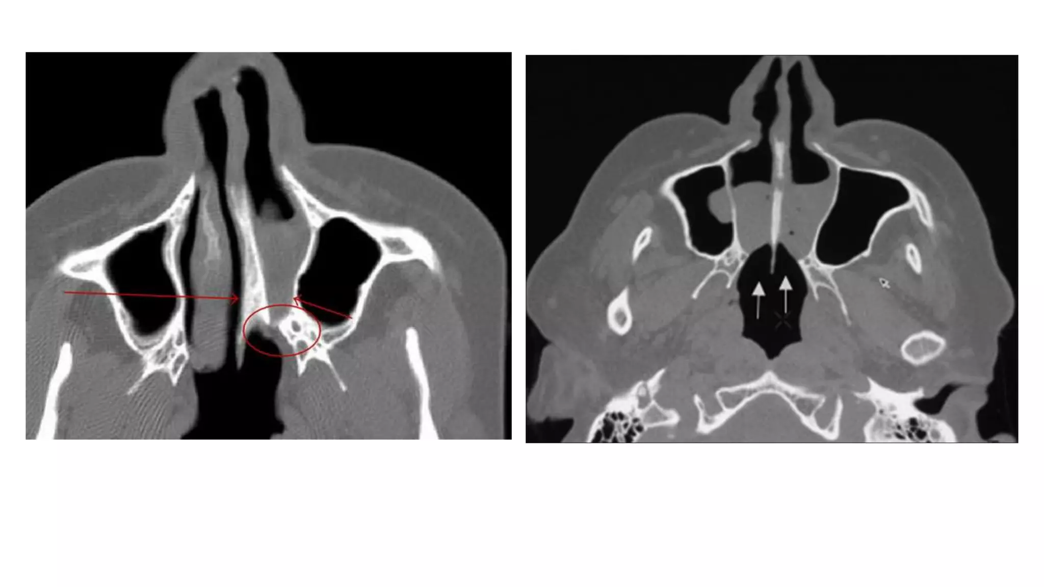 3. choanal atresia | PPTX